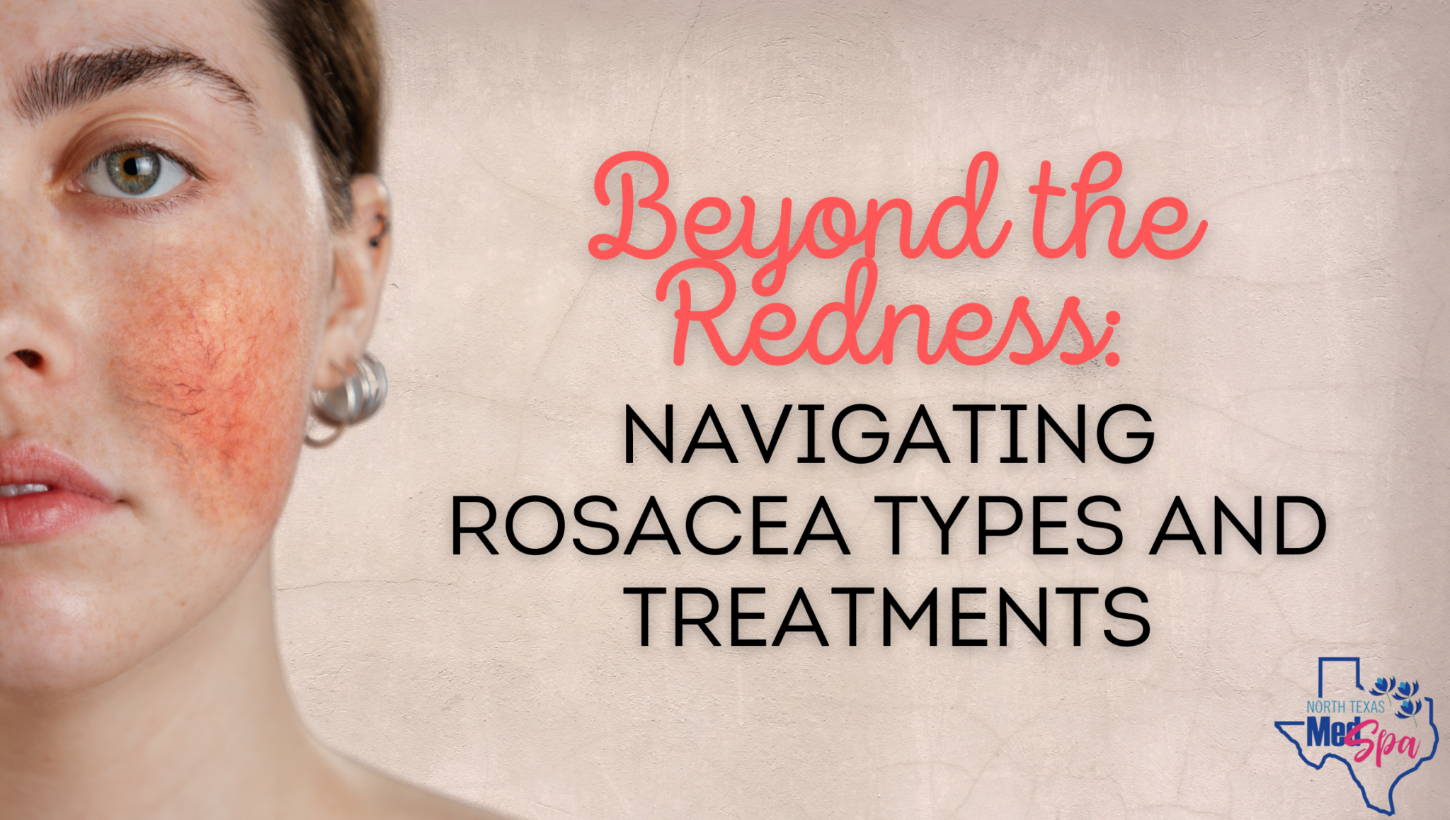 Navigating Rosacea Types and Treatments - North Texas MedSpa