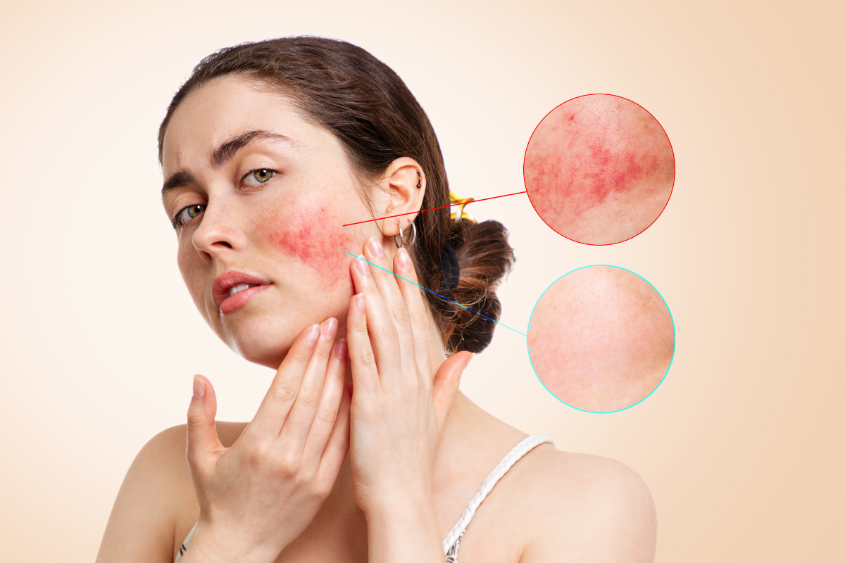 Navigating Rosacea Types and Treatments - North Texas MedSpa