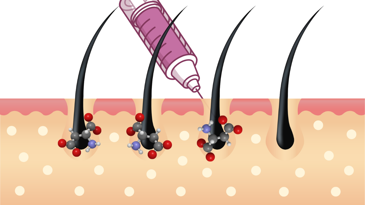 Hair Filler - North Texas MedSpa